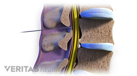 How Epidural Steroid Injections Work Spine Health