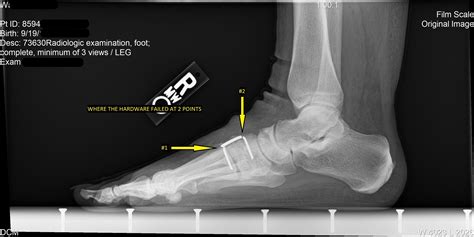 Dr Fixmyfoot Said That This Hardware Will Last The Rest Of My Life The Surgery To Repair The