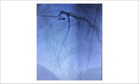 Spontaneous Multivessel Coronary Artery Dissection Case Report