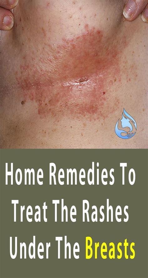 Best 13 Pimples On Breasts Causes And Home Remedies Artofit