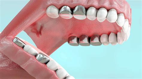What Is An Amalgam Replacement Paddington Dentistry Blog