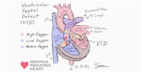 Ventricular Septal Defect — Pediatric Cardiologist Pediatric Heart