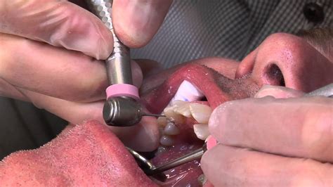 Invisalign Part 2 Interproximal Reduction Youtube