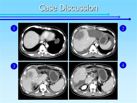 Ppt Staged Hepatectomy For Colorectal Metastases To Liver Powerpoint