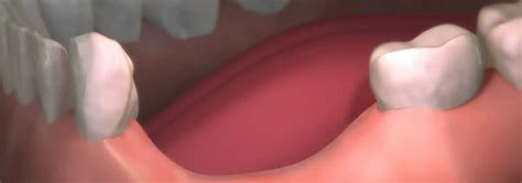 Ways To Prevent Bone Loss After Tooth Extraction The Sinus Lift