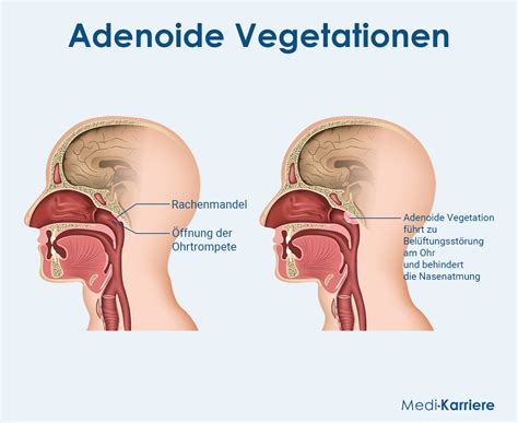 Adenoide Definition Lokalisation Und Polypen