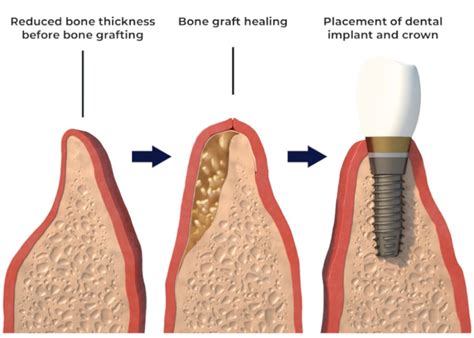 What Is Dental Bone Graft Material At Jeffrey Gavin Blog