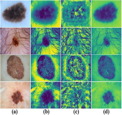 Mspan Multi‐scale Pyramid Attention Network For Efficient Skin Cancer Lesion Segmentation