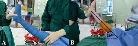 Optimizing Surgical Field Visualization In Total Knee Arthroplasty A