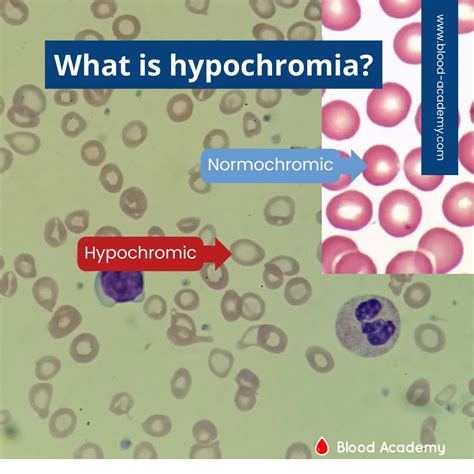 1 What Is Hypochromia And Morea Short Thread 🧵