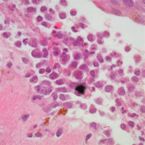 Skin Biopsy Showed Subepidermal Bullae In Which The Lumen Consists Of