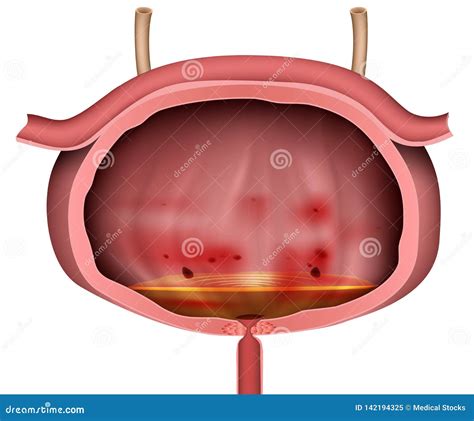 Appendicitis Inflammation Of The Appendix Colon The Illustration On Background
