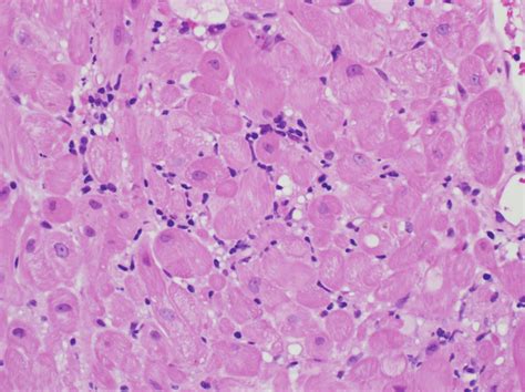 High Power View Of The Endomyocardial Biopsy Showing Patchy Lymphocytic Download Scientific
