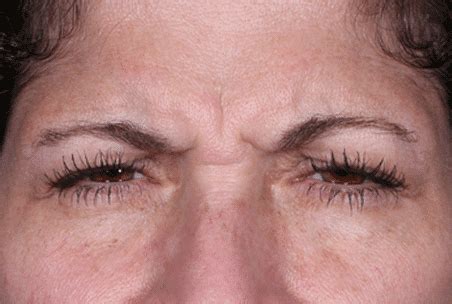 Daxxify Vs Botox Everything There Is To Know