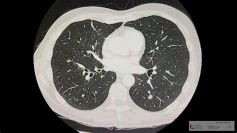 Alessio V Mariolo On Linkedin Thoracicsurgery Segmentectomy 3dreconstruction