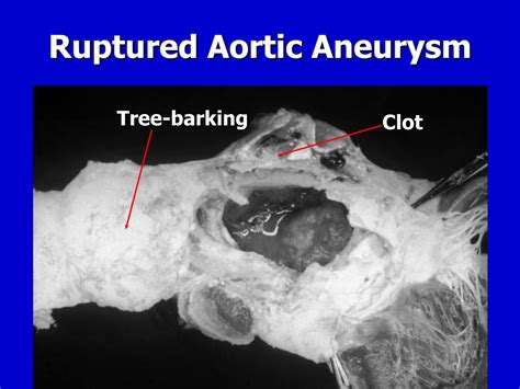 PPT Syphilis Clinical Aspects Of Late Syphilis PowerPoint Presentation ID