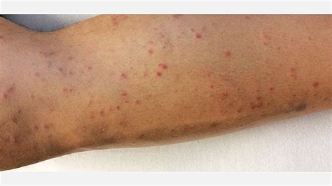 Thyroid Disease Medscape