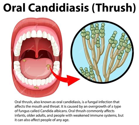 Free Vector Oral Candidiasis Thrush Infographic With Explanation