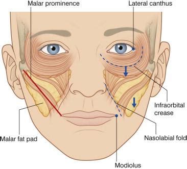 Lamellar High Smas Minimum Incision Face Lift Clinical Tree
