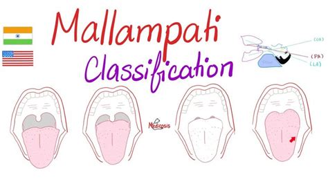 Mallampati Score Classification For Airway Management Airway