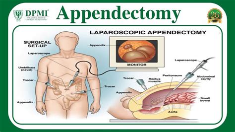 Appendectomy Appendix Removal Surgery Two Types Of Appendectomy