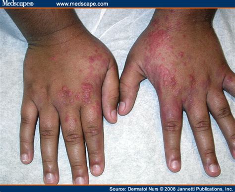 Polymorphic Light Eruption