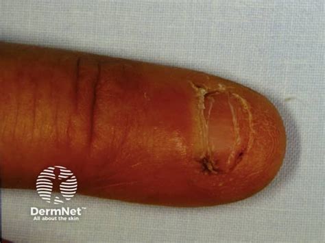 Nail Terminology