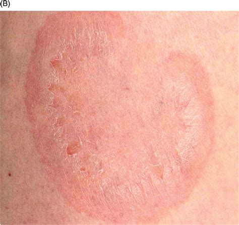 Superficial Perivascular Dermatitis Treatment Captions Cute Viral