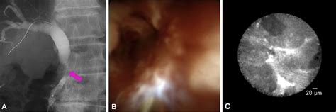 A Cholangiography Showed The Lesion Pink Arrow B Peroral Download Scientific Diagram
