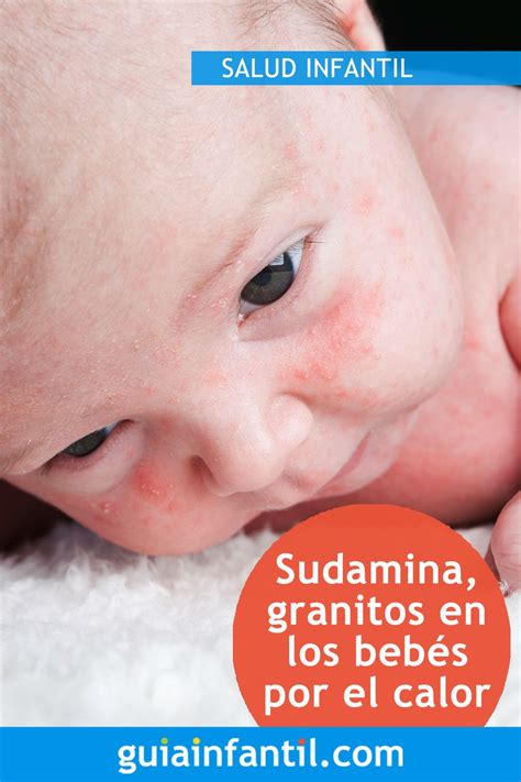 Sudamina Granitos En Los Bebés Por El Calor Granitos En La Cara
