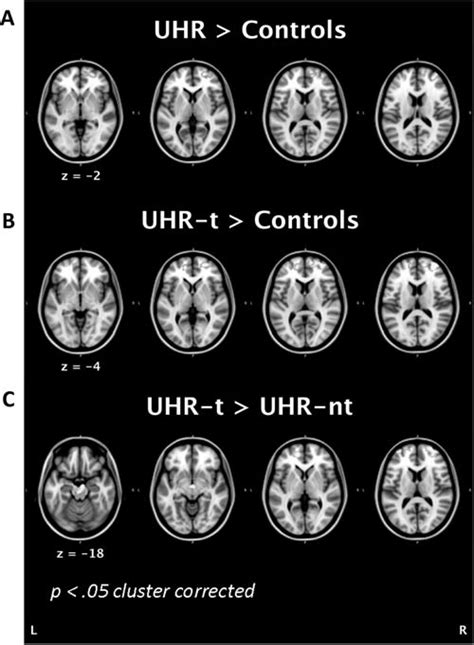 Statistical Parametric Maps Spms Showing Regions Of Greater Download Scientific Diagram
