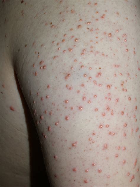 Eruptive Yellowish Red Papules In A Fat Youth European Journal Of