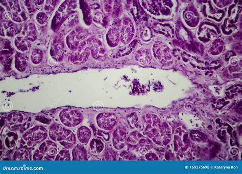 Diffuse Proliferative Glomerulonephritis Stock Photo Image Of Renal