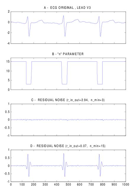 High Frequency Noise Filtration Of Ecg Signal Without Emg Noise Lead