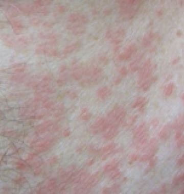 Skin Rash And Sexually Transmitted Diseases Symptoms 43 OFF