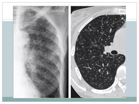 Role Of Radiology In Pulmonary Tuberculosis Pptx