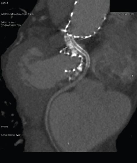 Six Month Follow Up Results After Tavr A Cardiac Computed Tomography Download Scientific