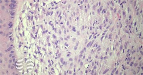 Epithelioid Histiocytoma Pathology Image