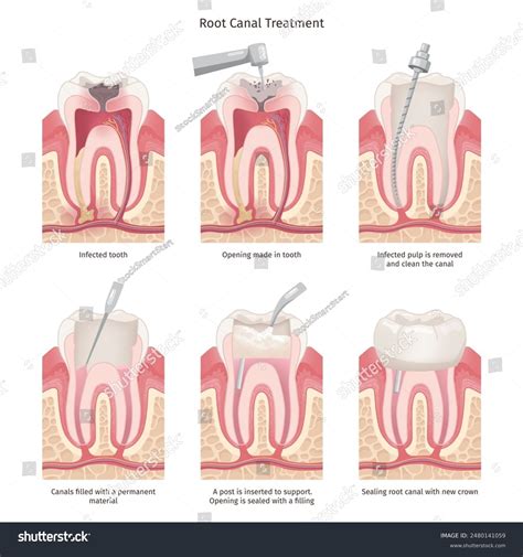 Root Canal Clipart Root Canal Get Reduced Cost In Australia