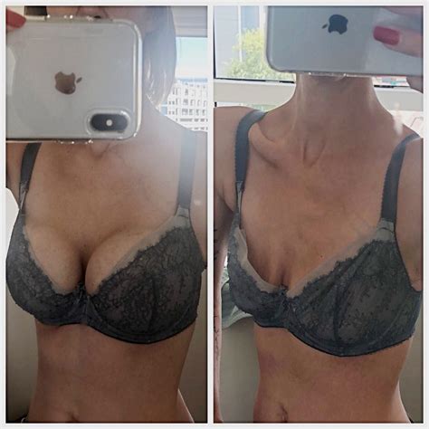 What Happened When I Had My Breast Implants Removed By Upvirket Medium