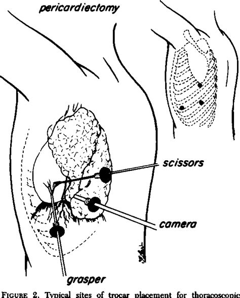 Pericardial Window Procedure Video