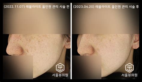 대전 피코슈어 레이저토닝으로 기미를 치료하는 과정에 대하여 네이버 블로그