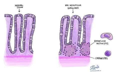 Crohns Disease Pathology Dictionary Mypathologyreport Ca