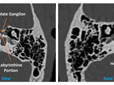 Scutum Temporal Bone