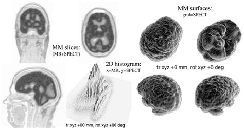 Several Ways Of Aligning Multimodality Mr And Spect Images Images