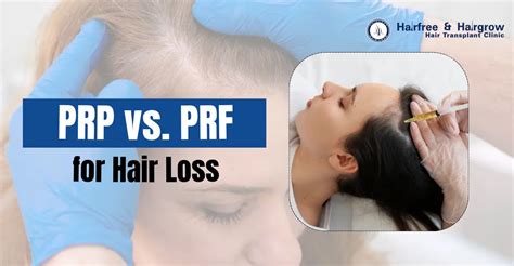 Prp Vs Prf The Best Treatment For Hair Loss Explained