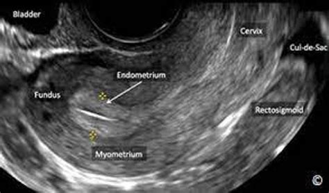 Female Pelvic Anatomy Ultrasound