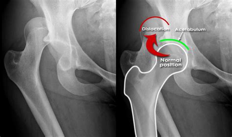 Hip Dysplasia X Ray Positioning At Mickey Munos Blog