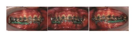 Segmented Technique And Intra Arch Elastics To Close Extraction Space