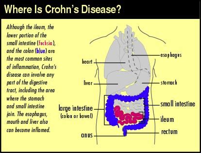 ABC Series Caring For Crohn S UC
